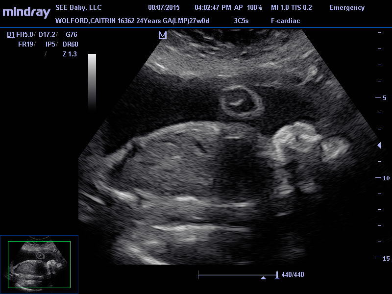 Brielle’s 27 Week Ultrasound Pictures